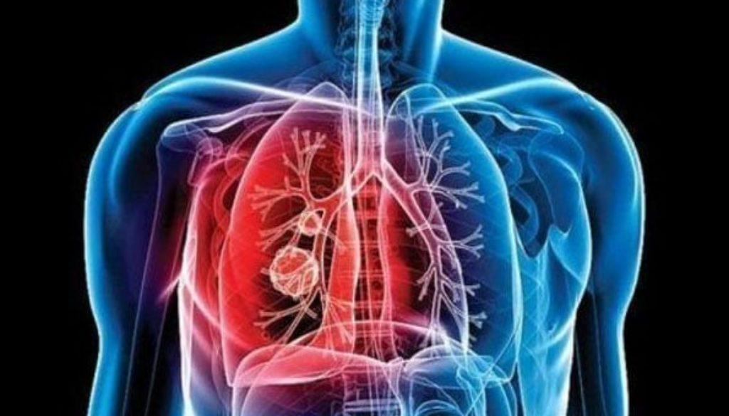 Neumonólogo pide no normalizar tos recurrente tras brote de tuberculosis
